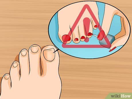 Como Quitar Uñas Amarillas De Los Pies favorcought