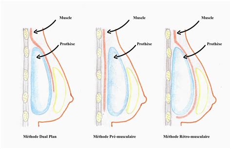 Tout Savoir Sur L Augmentation Mammaire Rebornly