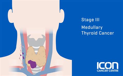 Thyroid Cancer Types Signs Symptoms Stages