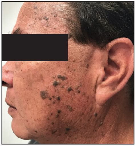 Inflamed Seborrheic Keratosis