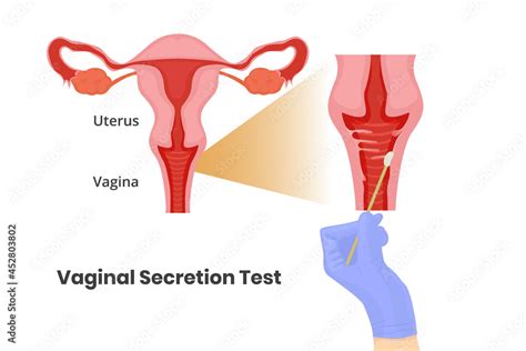 Vaginal Secretion Test Vaginal Swab Vecor Illustration Stock Vector