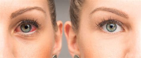 Red Eyes Infection Causes Symptoms And Treatment Bloodshot Eyes
