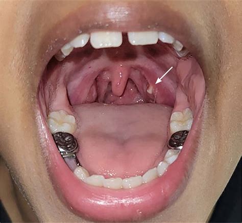 Tonsil Stone Definition Symptoms And Treatment