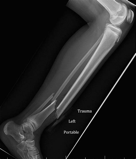 Loss Of Reduction And Malunion After Cortical Perforation During