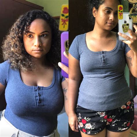 Mamoplastia Redutora Antes E Depois