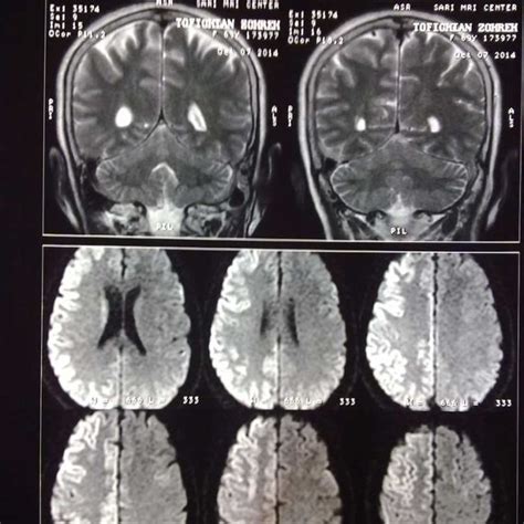 The Brain Magnetic Resonance Imaging Diffusion Weighted Imaging Shows