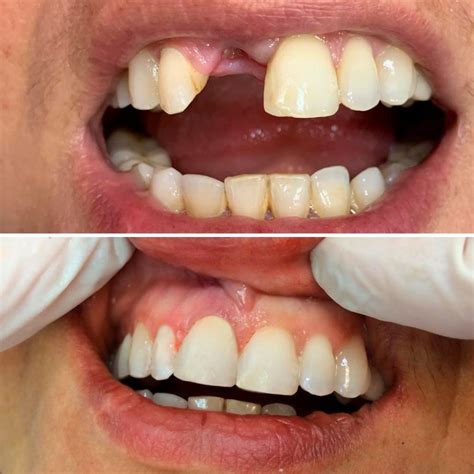 Implante Dentário Só Sorriso Odontologia Recreio do Bandeirantes