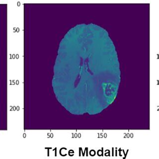 Visualization Of Magnetic Resonance Imaging Mri Images From Brats