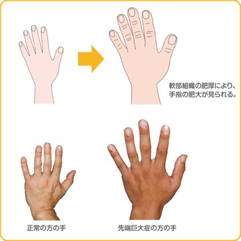 先端肥大症 Welcome To 佐野内科ハートクリニック