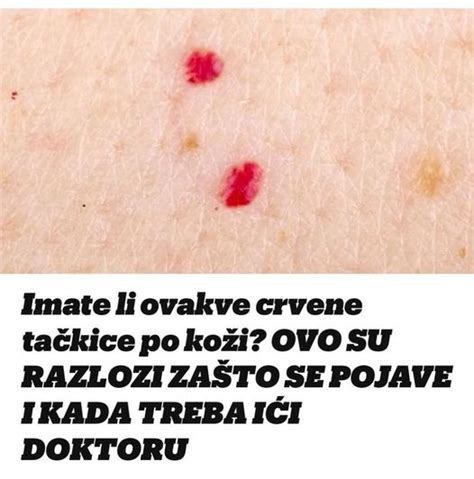 Imate li ove crvene mrlje na koži Evo zašto se pojavljuju i kada biste
