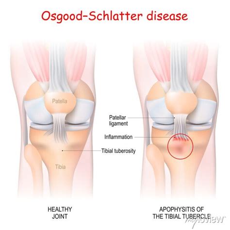 Osgoodschlatter Disease Healthy Joint And Apophysitis Of The Posters