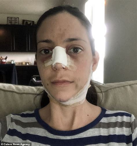 Single Mom Spends 30 000 On Plastic Surgery To Look Like Meghan Markle