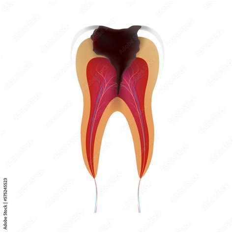 Tooth Caries Stages Development Of Teeth Decay With Enamel And Dentin