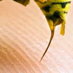 Wasp Stinger In Skin