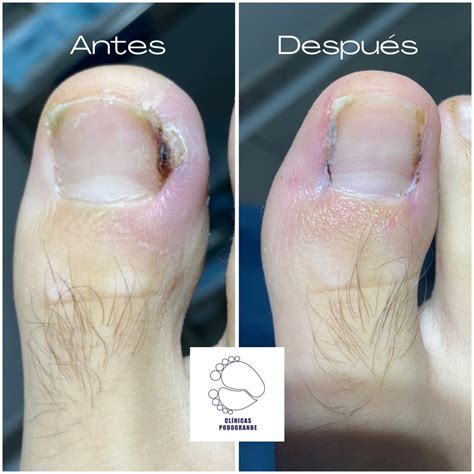 Onicocriptosis o Uña encarnada Clinica podologica Madrid