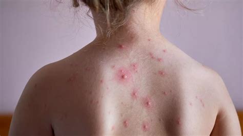 Dr Miriam Stoppard If You Ve Had Chickenpox You Could Develop Shingles