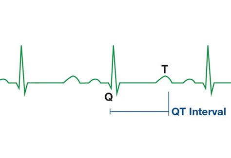 Long Qt Syndrome Symptoms And Causes Mayo Clinic