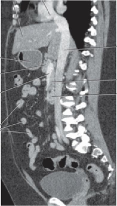 Sagittal Ct Abdomen Diagram Quizlet