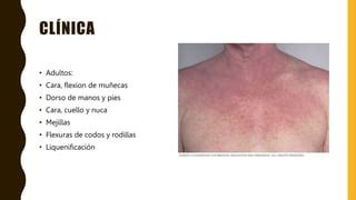 Dermatitis Atopica PPT Descarga Gratuita