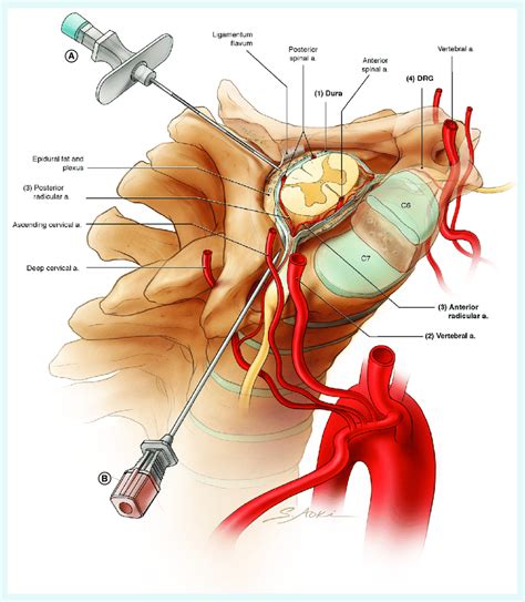 Interlaminar A And Transforaminal B Epidural Injections At The C6 7