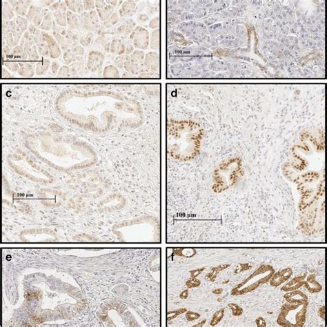 HIF 1alpha And CAIX Expression In PDAC And Adjacent Normal Pancreatic