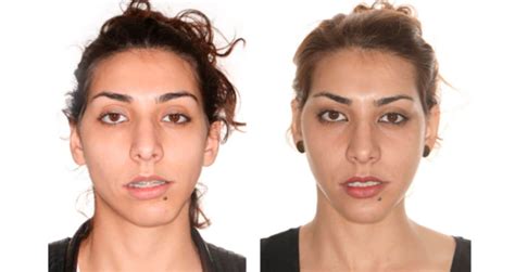 Silvia Asimetría Facial Instituto Maxilofacial