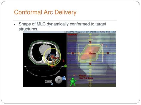 an overview of imrt vmat optimization algorithms