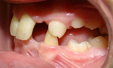 Multiple Missing Teeth Platinum Orthodontics