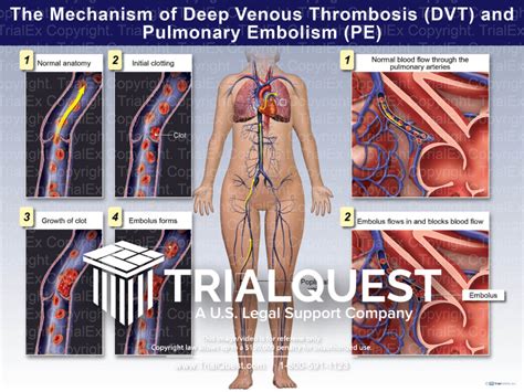 The Mechanism Of Deep Vein Thrombosis Dvt And Pulmonary Embolis