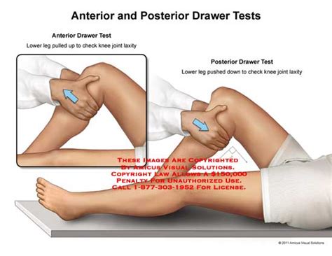 Anterior And Posterior Drawer Tests