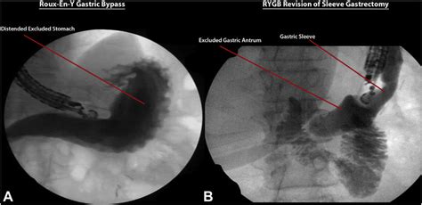 Fluoroscopic Opacification Of The Excluded Stomach In A Roux En Y