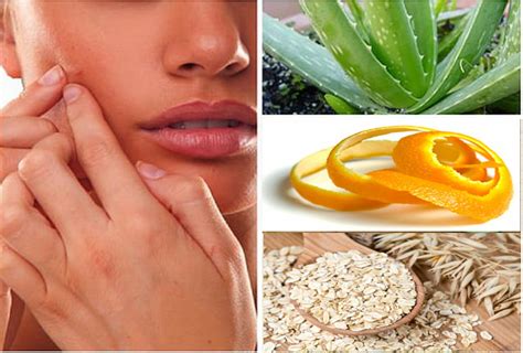 Remedios Caseros Para El Acné Tienda naturista salud y paz