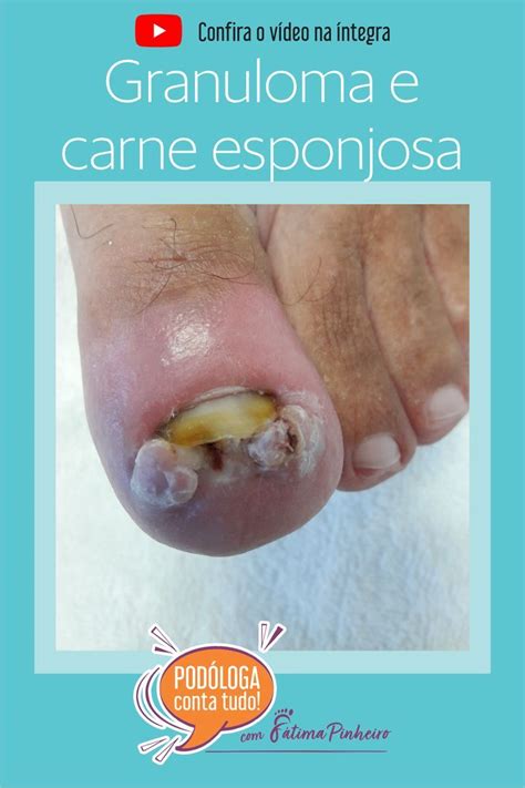 Também conhecido como carne esponjosa o granuloma é bastante dolorido
