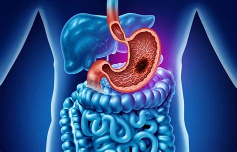 Silent Signs Of Stomach Cancer To Read Now Indulging Health