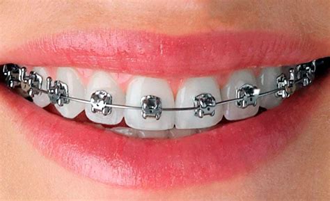 Cuanto Cuesta Ponerse Brackets Precios Por Tipo De Material 2024