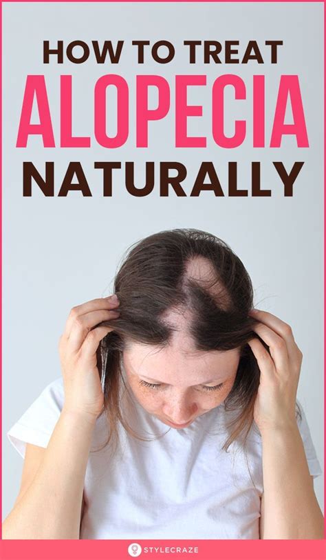 Alopecia Causes Artofit
