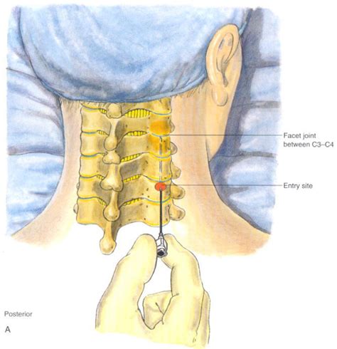 Facet Joint Injections Dr Michael A Castillo MD