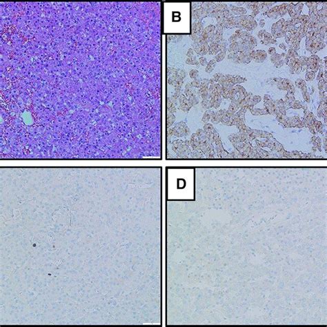 Histology And Immunohistochemistry Of Parathyroid Adenoma A