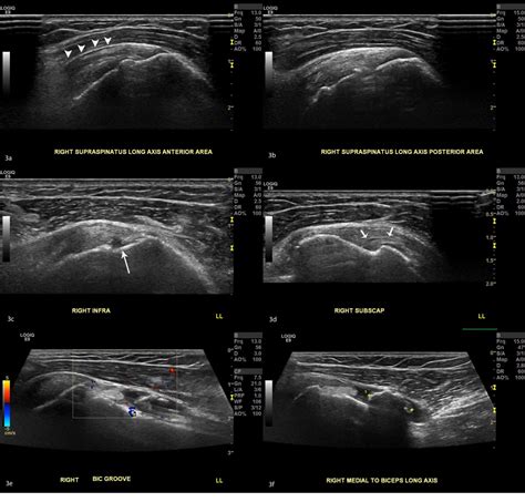 Figure From Influenza Vaccine Related Subacromial Subdeltoid Bursitis