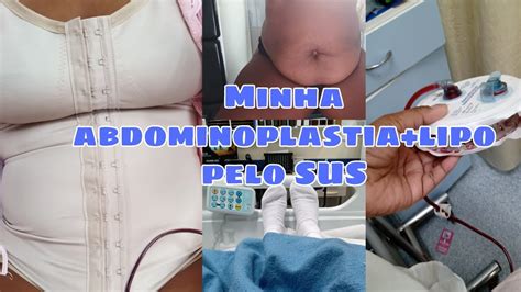 Minha Abdominoplastia Lipo Pelo SUS Antes Depois YouTube