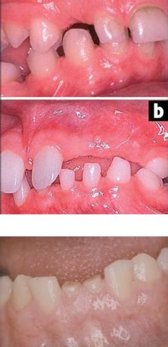 OD21 Abnormalities Of Teeth Flashcards Quizlet