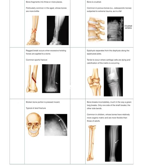 Types Of Fractures Diagram Quizlet