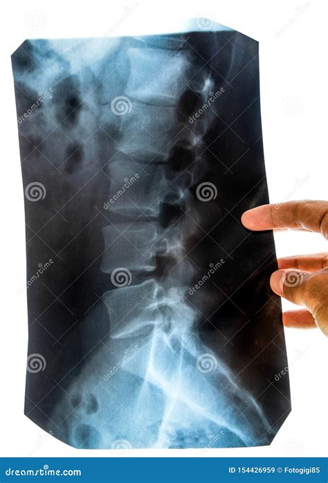 X Rayo De La Espina Dorsal Lumbar Espina Dorsal En Radiograf A Imagen