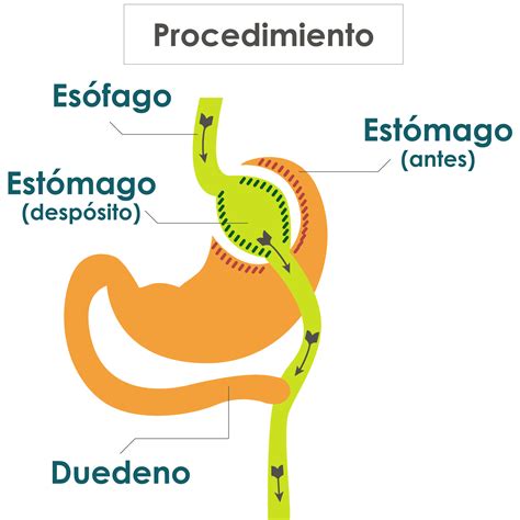 Gastric Bypass Medellín Colombia A good positive health is a new life