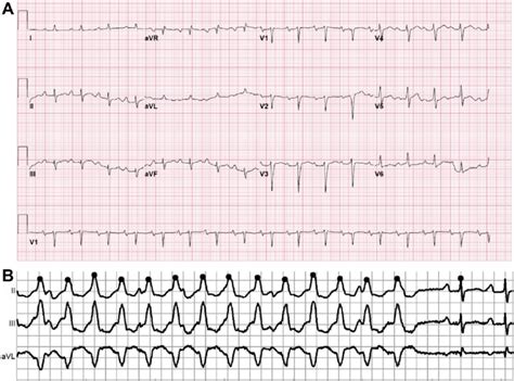 A Electrocardiogram ECG Showing Sinus Tachycardia With First Degree
