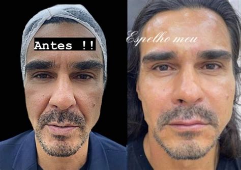 André Gonçalves faz harmonização facial veja antes e depois