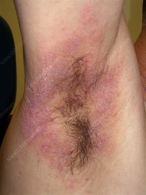 Seborrheic Dermatitis Stock Image C056 5168 Science Photo Library