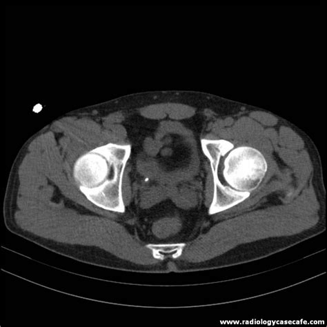Abdomen Radiology Case Cafe