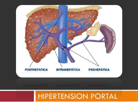 Hipertensi N Portal Alicia Castillo Udocz