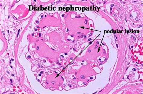 Kidney Disease And Renal Failure Flashcards Quizlet